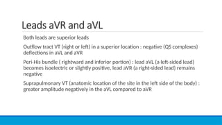 ECG -Ventricular tachycardia localisation .pptx
