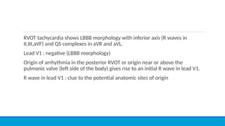 ECG -Ventricular tachycardia localisation .pptx