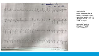 ECG -Ventricular tachycardia localisation .pptx