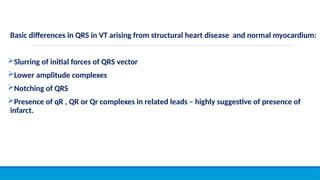 ECG -Ventricular tachycardia localisation .pptx