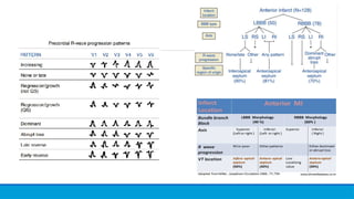ECG -Ventricular tachycardia localisation .pptx