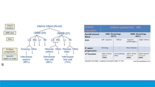 ECG -Ventricular tachycardia localisation .pptx