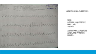 ECG -Ventricular tachycardia localisation .pptx