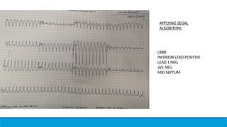 ECG -Ventricular tachycardia localisation .pptx