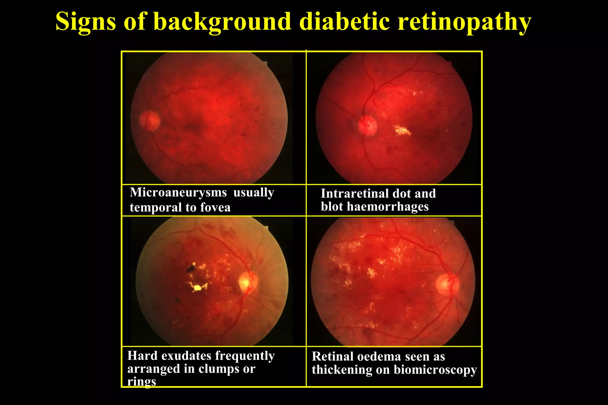 49 diabetic retinopathy | PPT