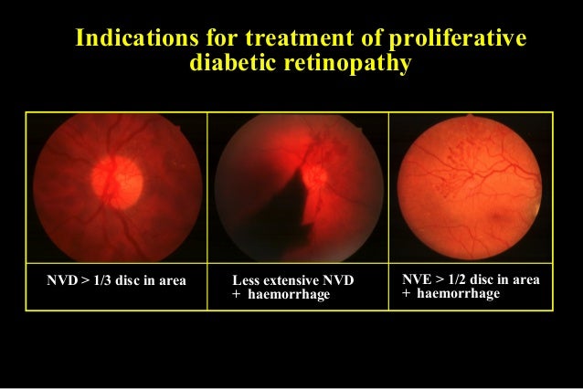 49 diabetic retinopathy