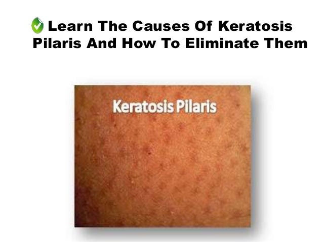 Keratosis Pilaris African American