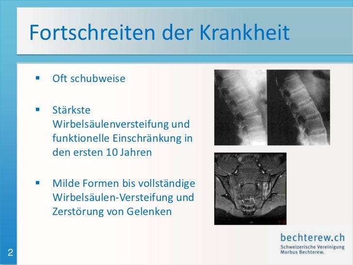 Krankheitsbild Morbus Bechterew