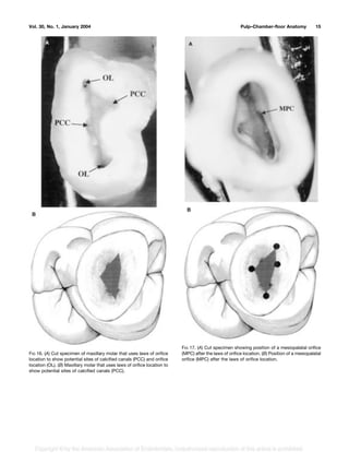 Anatomy of the Pulp-Chamber Floor | PDF