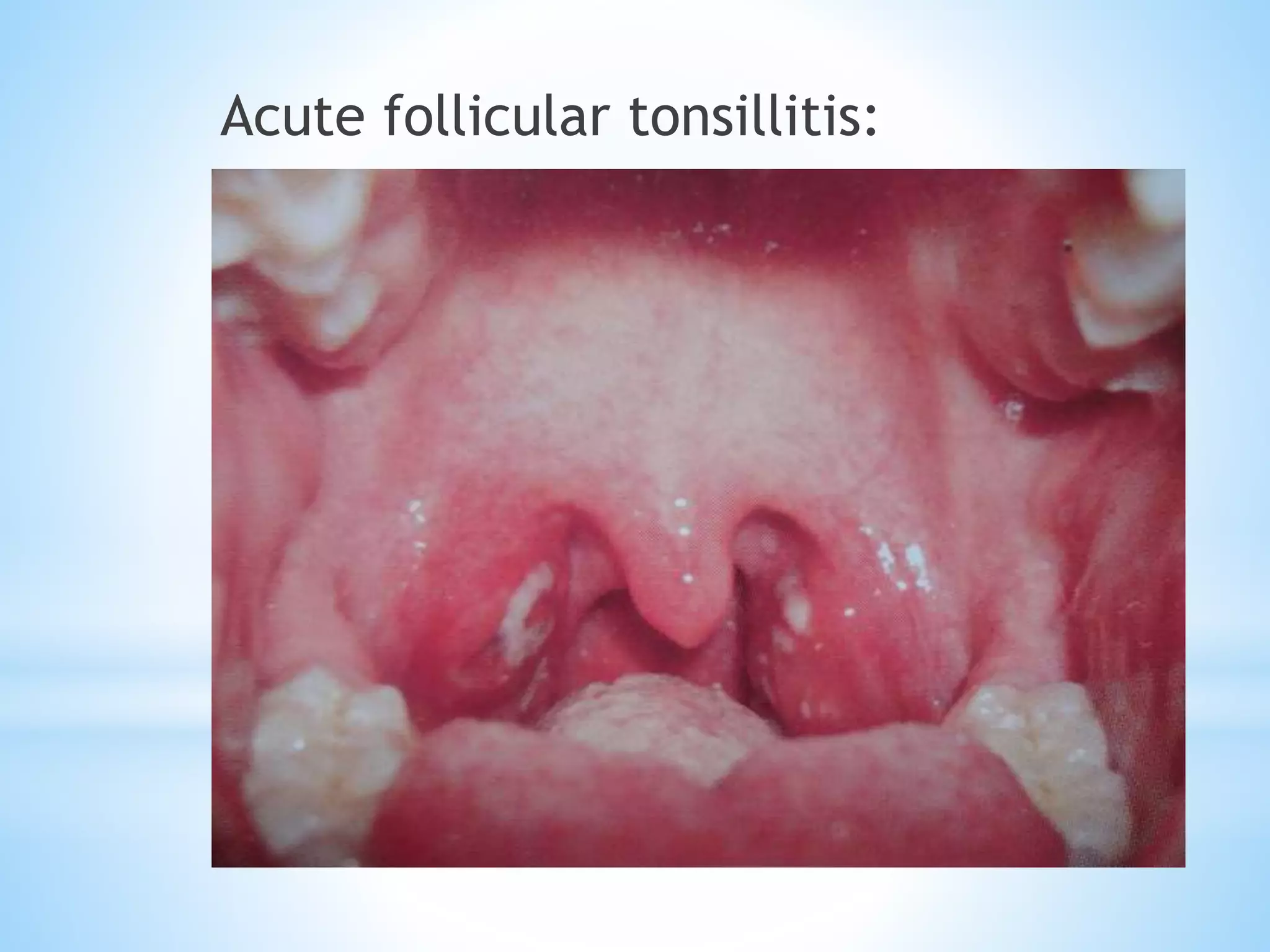 acute tonsillitis | PPTX