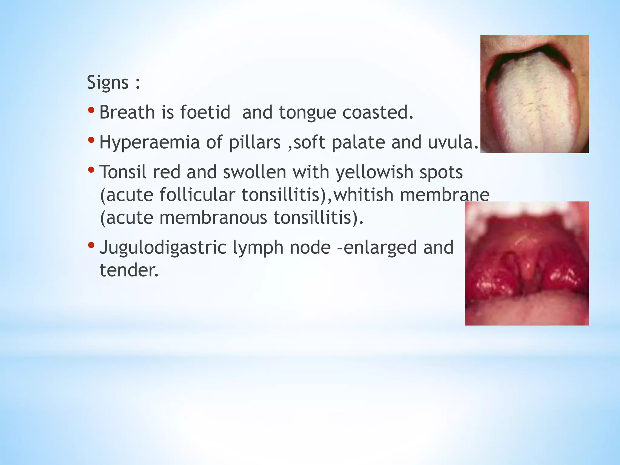 acute tonsillitis | PPTX