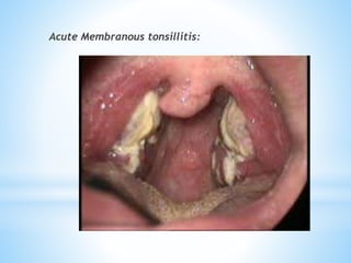 acute tonsillitis | PPTX