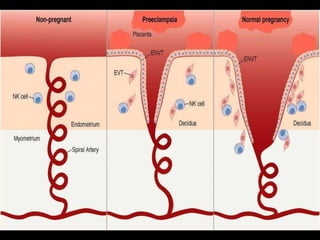 pre eclampsia | PPTX