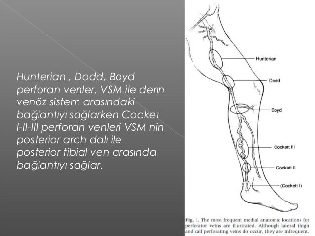Kronik venoz yetmezlik tedavisinde seps uygulamalari
