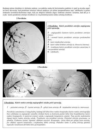 Krūtinės angos sindromas, komplikuotas poraktinės arterijos aneurizma ...