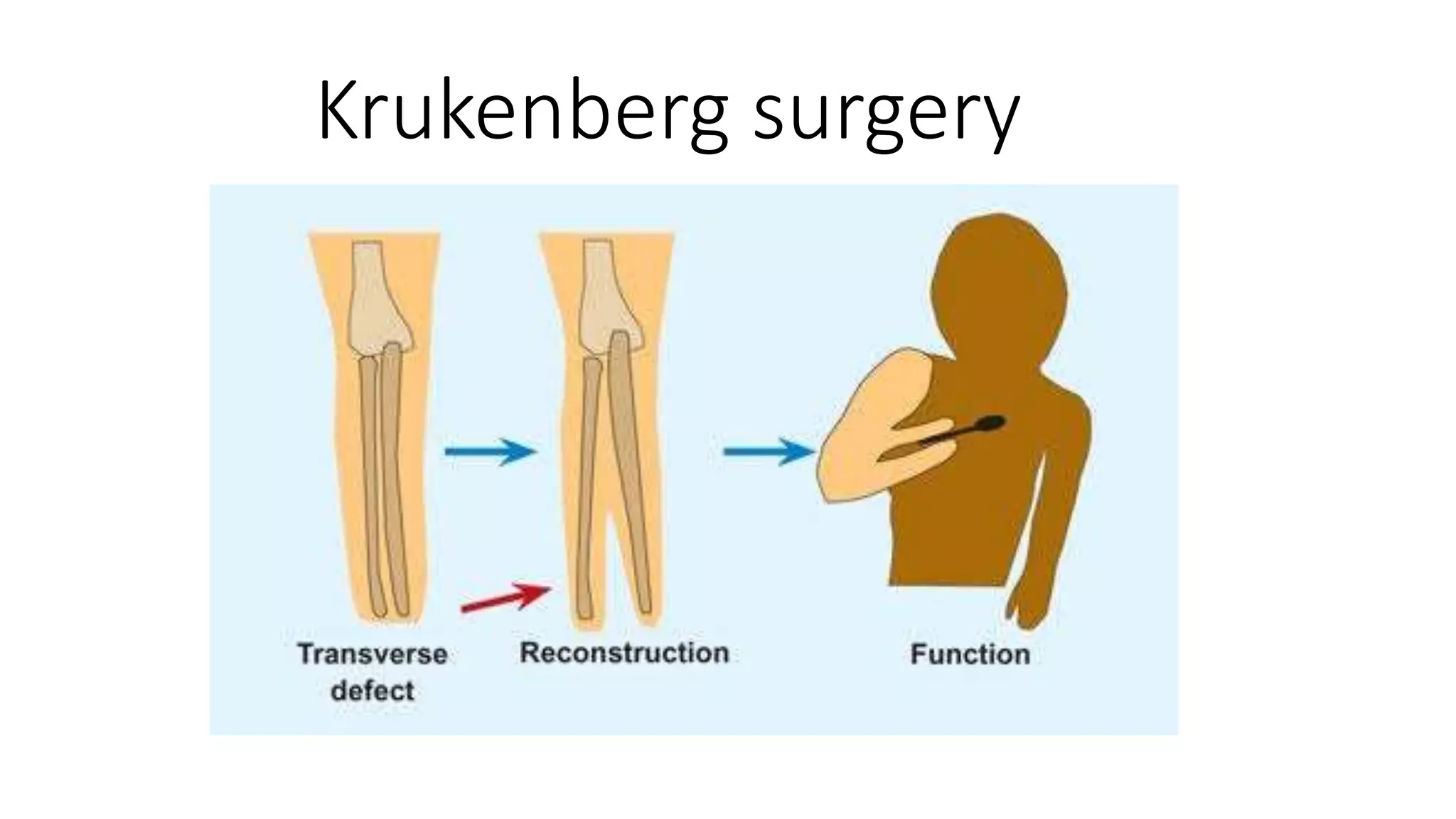 Krukenberg surgery | PPTX