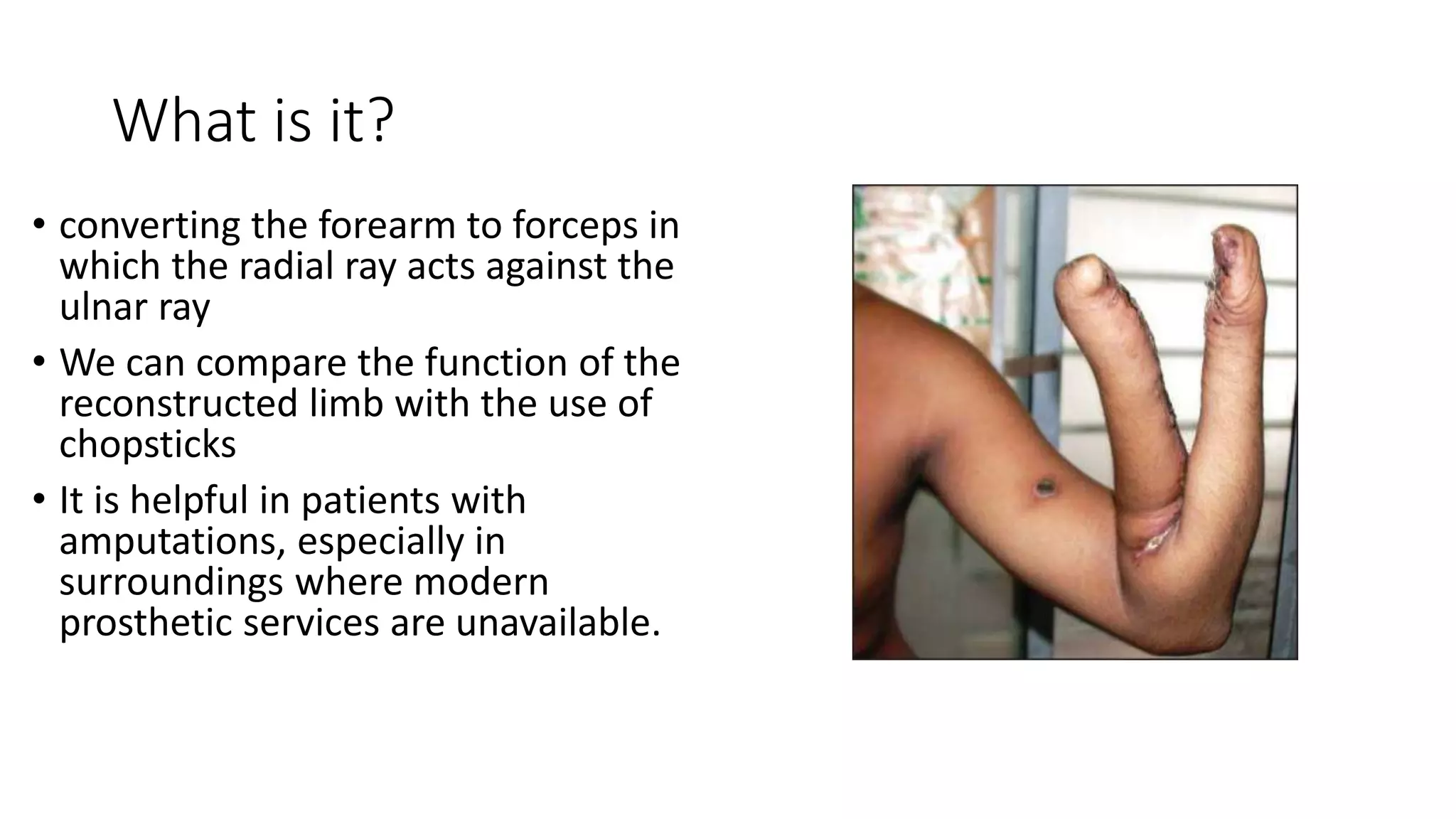 Krukenberg surgery | PPTX