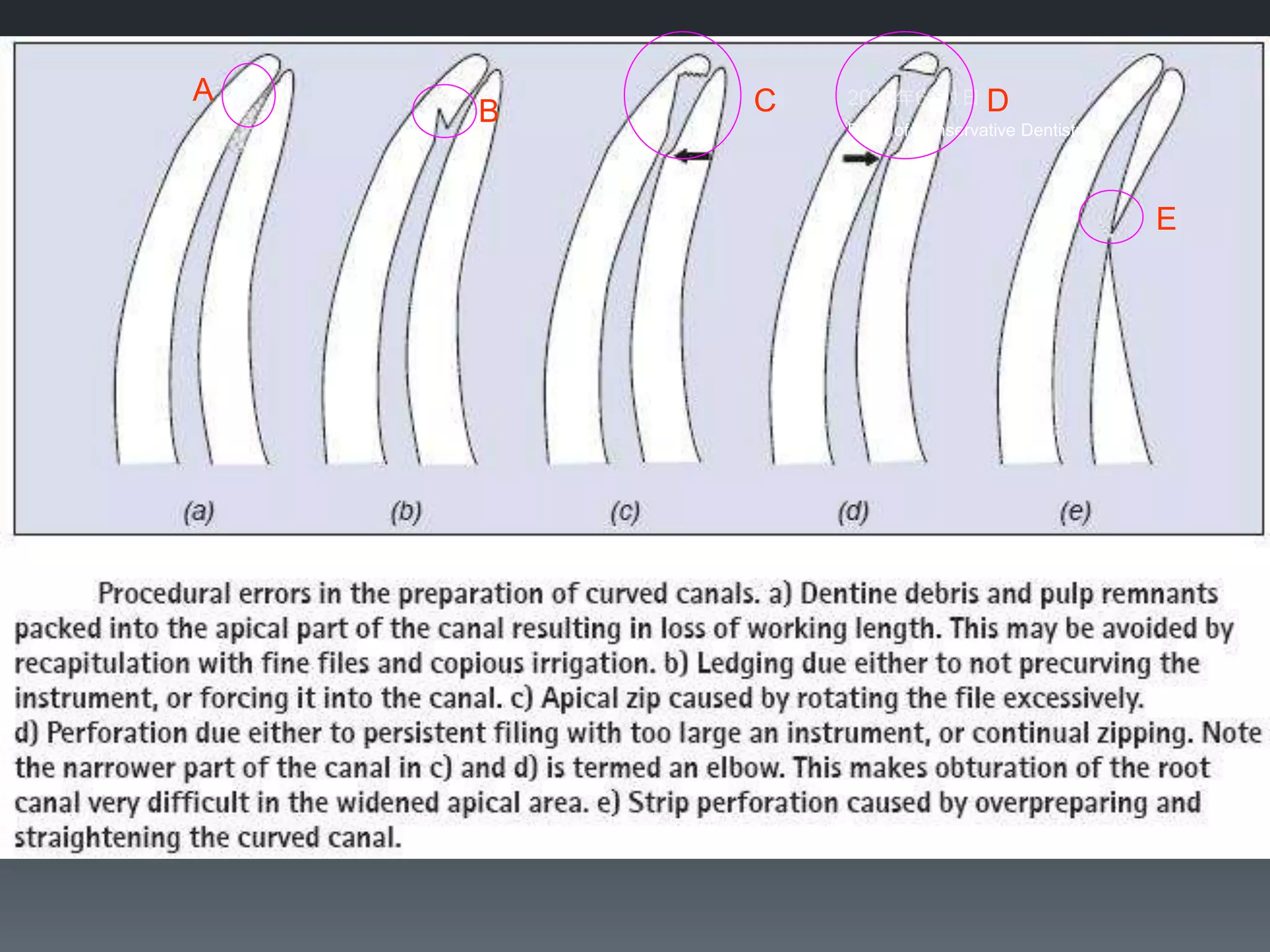 Access Cavity Prepration | PPTX