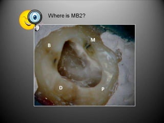 Access Cavity Prepration | PPTX
