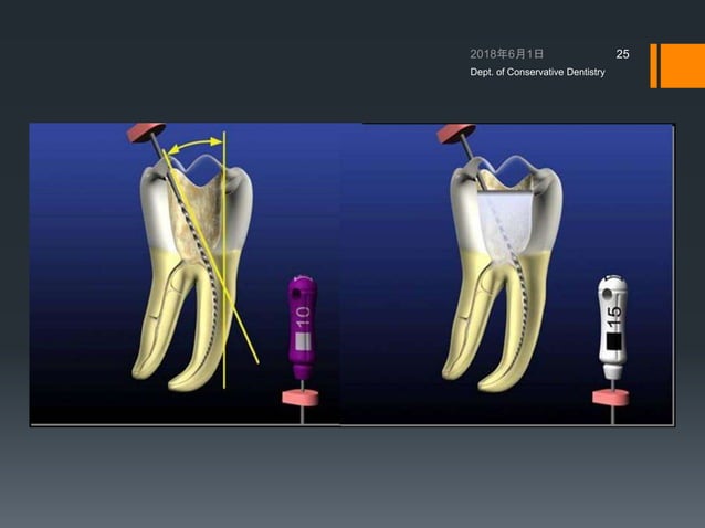 Access Cavity Prepration | PPTX