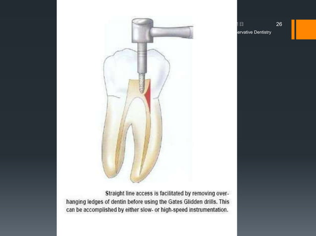 Access Cavity Prepration | PPTX