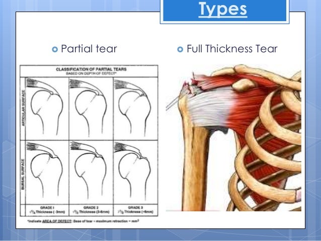 Shoulder Pathology and the Industrial Athlete