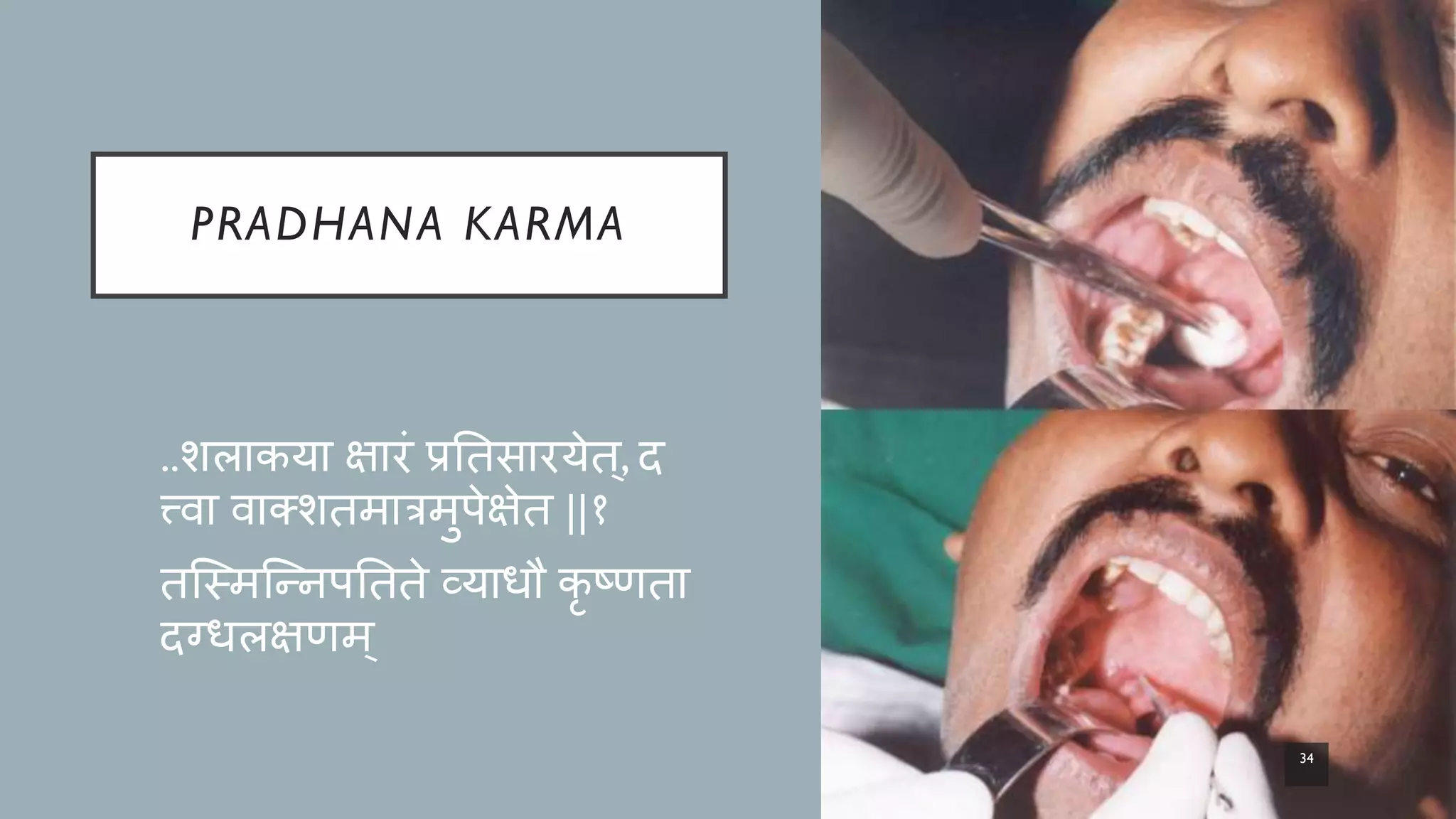 Kshara karma agni karma in shalakya | PPTX