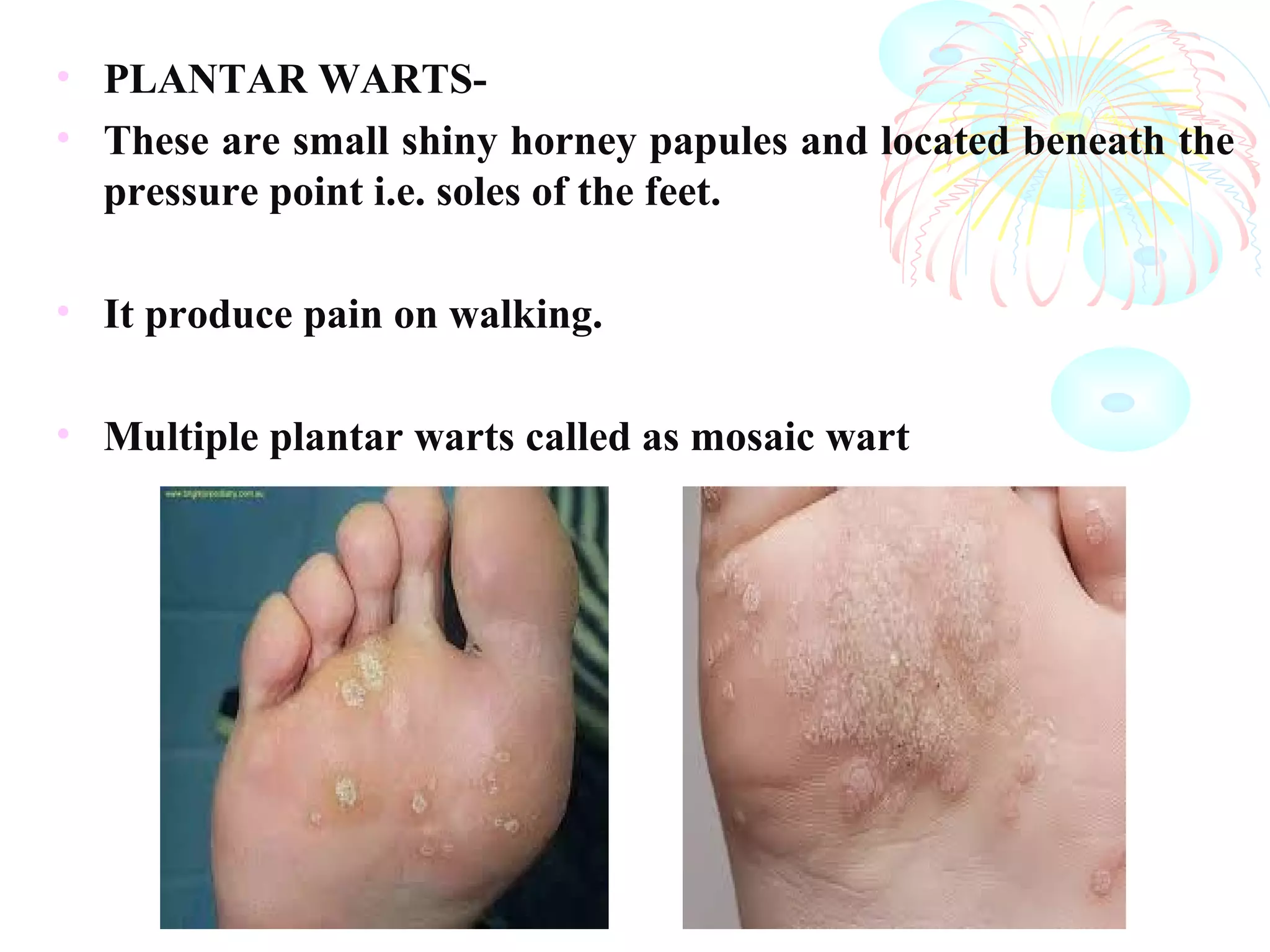 Ksharodhaka injection....treatment of warts...charmakila | PPT