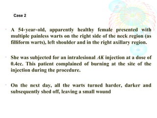 Ksharodhaka injection....treatment of warts...charmakila | PPT
