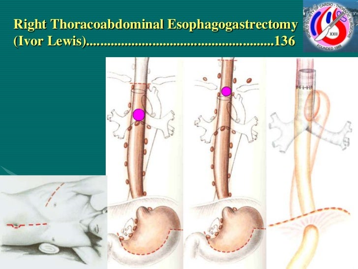 Kshivets O. Esophageal & Cardioesophageal Surgery