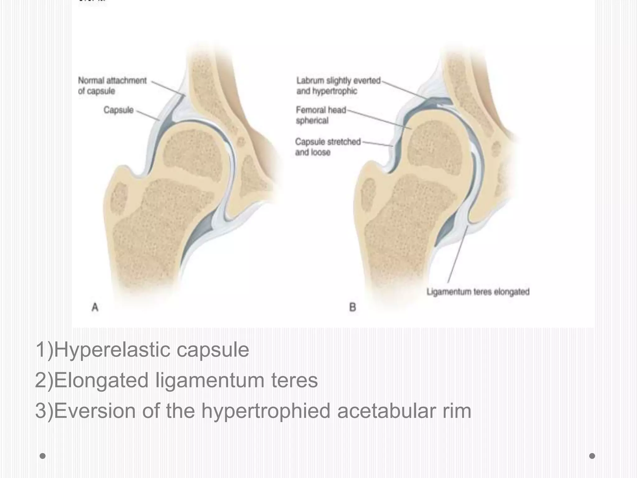 Developmental dysplasia of hip | PPTX