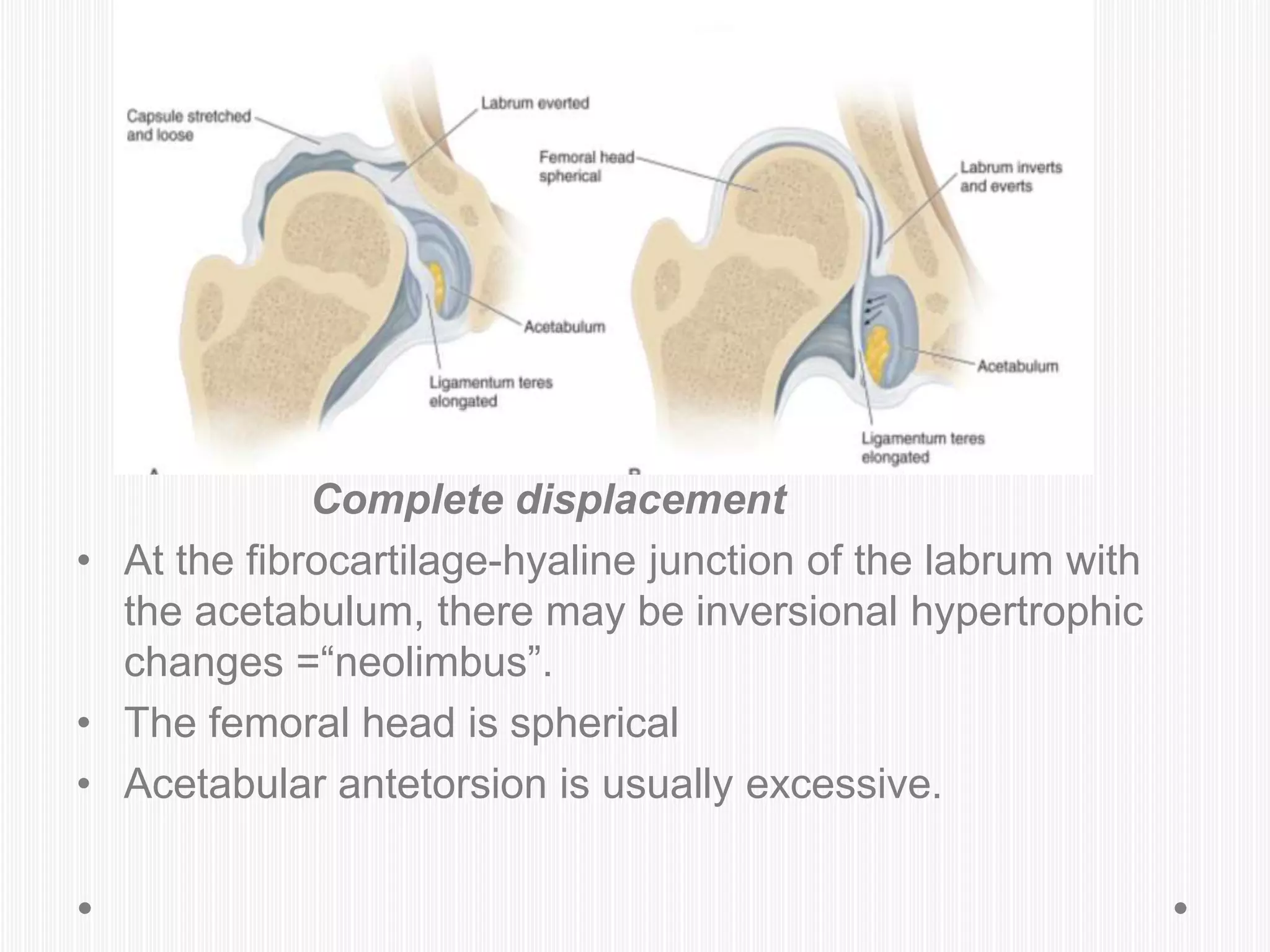 Developmental dysplasia of hip | PPTX