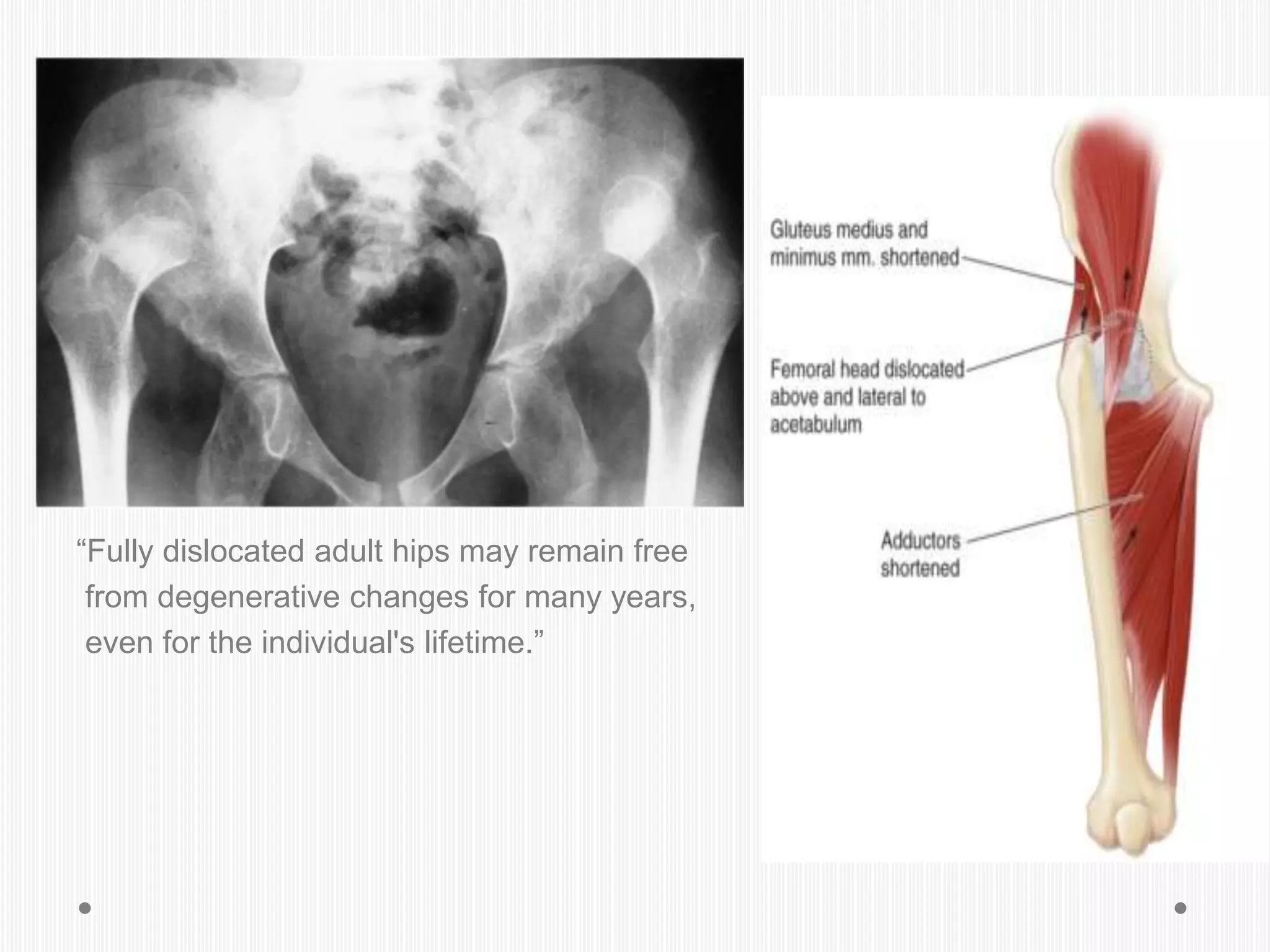 Developmental dysplasia of hip | PPTX