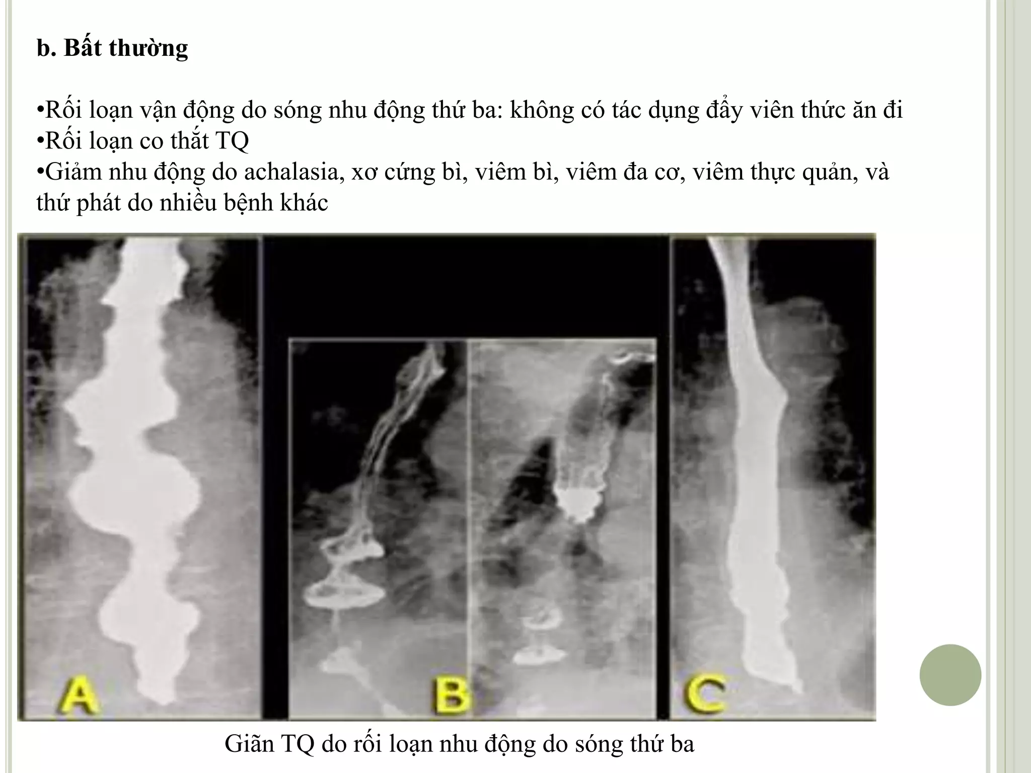 Kĩ thuật chụp x quang nâng cao thực quản | PPTX