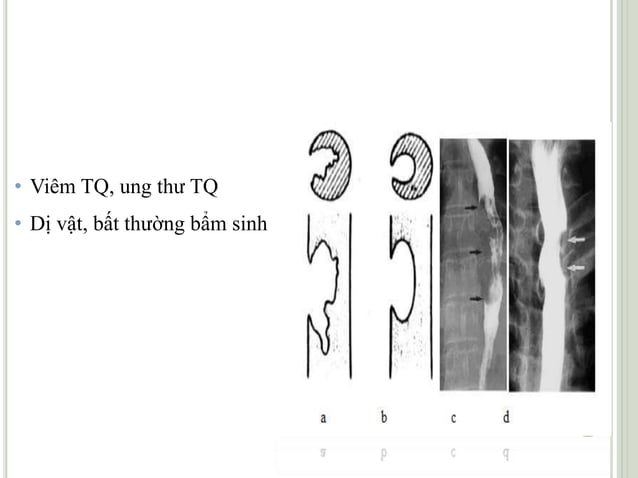 Kĩ thuật chụp x quang nâng cao thực quản | PPTX