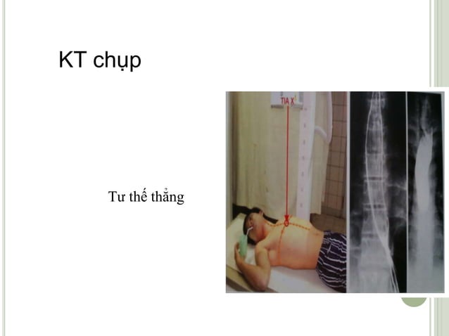 Kĩ thuật chụp x quang nâng cao thực quản | PPTX