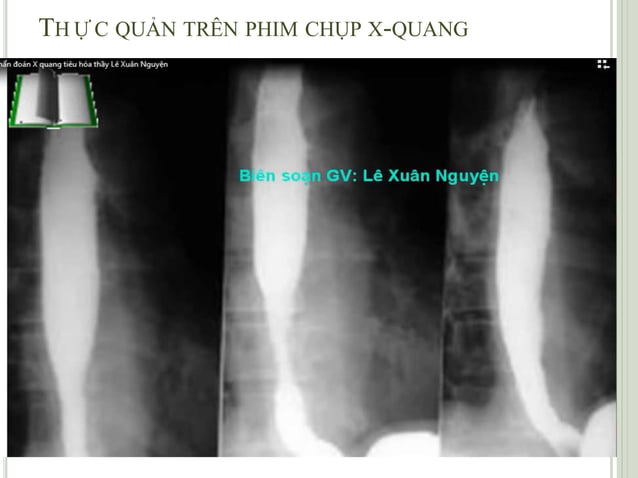 Kĩ thuật chụp x quang nâng cao thực quản | PPTX