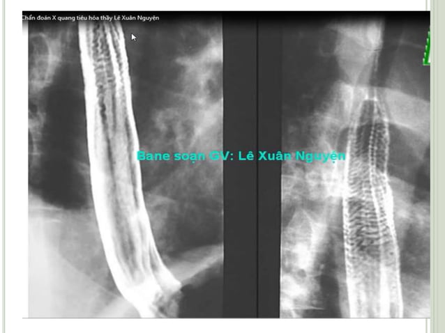 Kĩ thuật chụp x quang nâng cao thực quản | PPTX