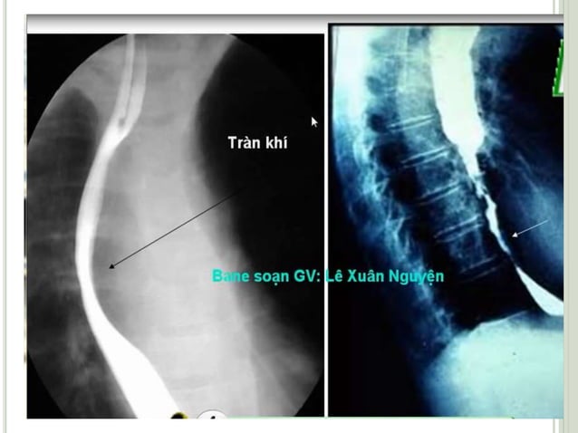 Kĩ thuật chụp x quang nâng cao thực quản | PPTX