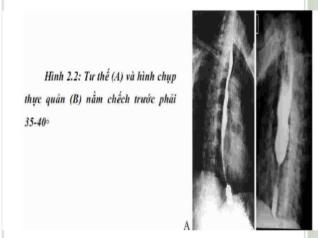 Kĩ thuật chụp x quang nâng cao thực quản | PPTX