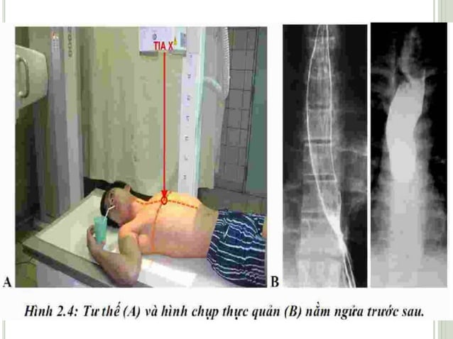 Kĩ thuật chụp x quang nâng cao thực quản | PPTX