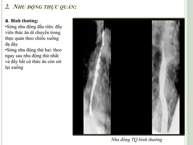 Kĩ thuật chụp x quang nâng cao thực quản | PPTX