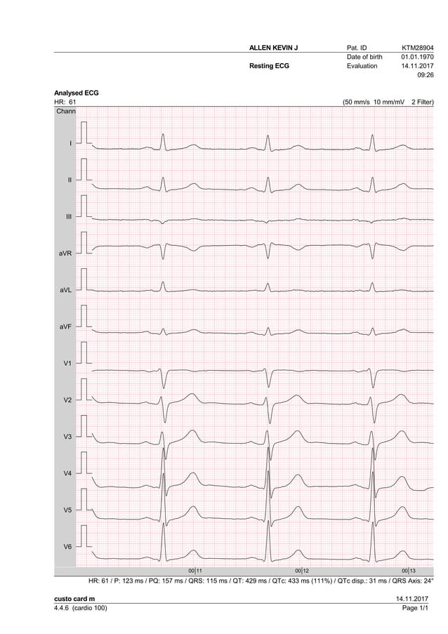 ecg | PDF