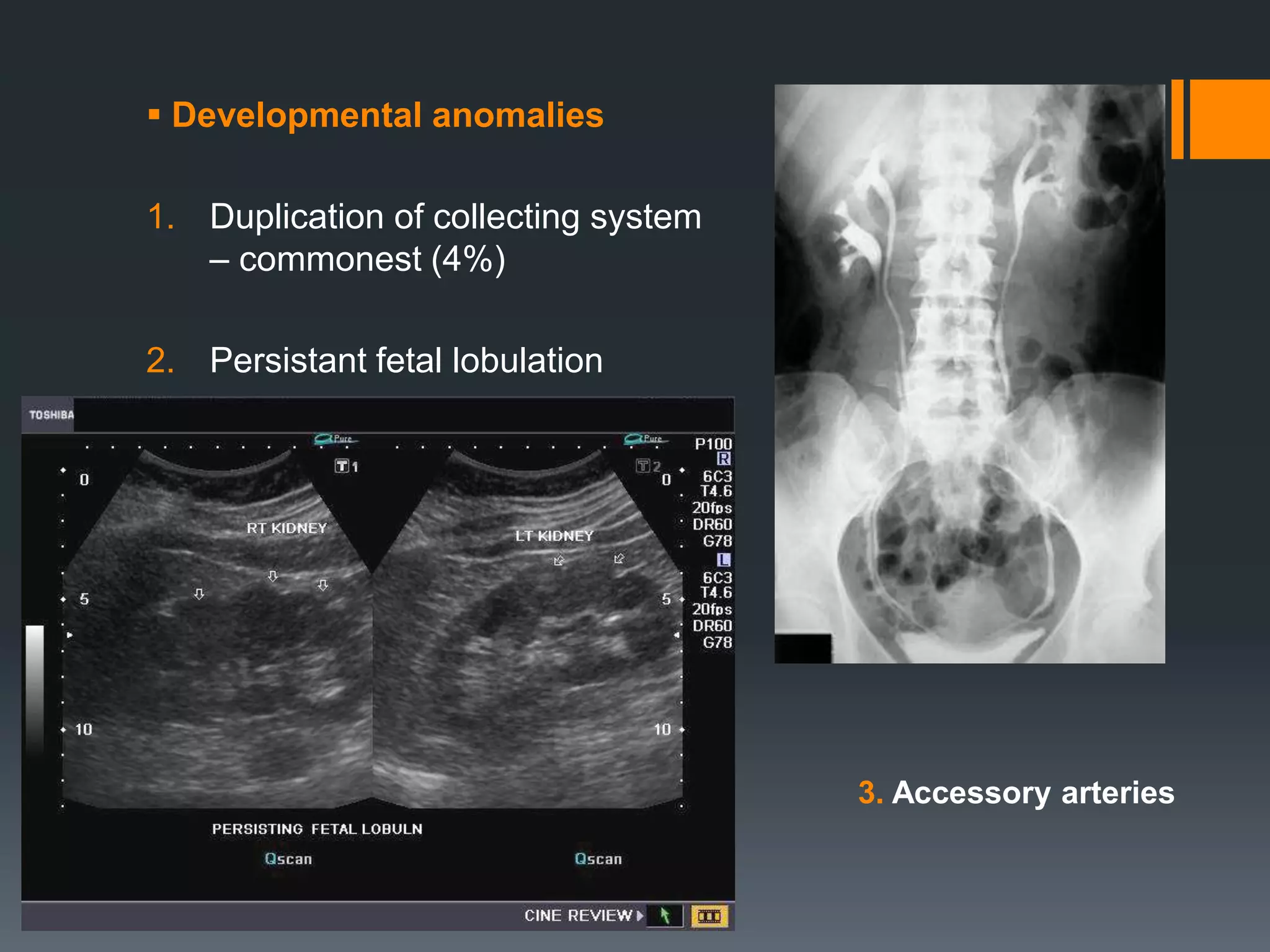 Kub - xray and usg | PPTX