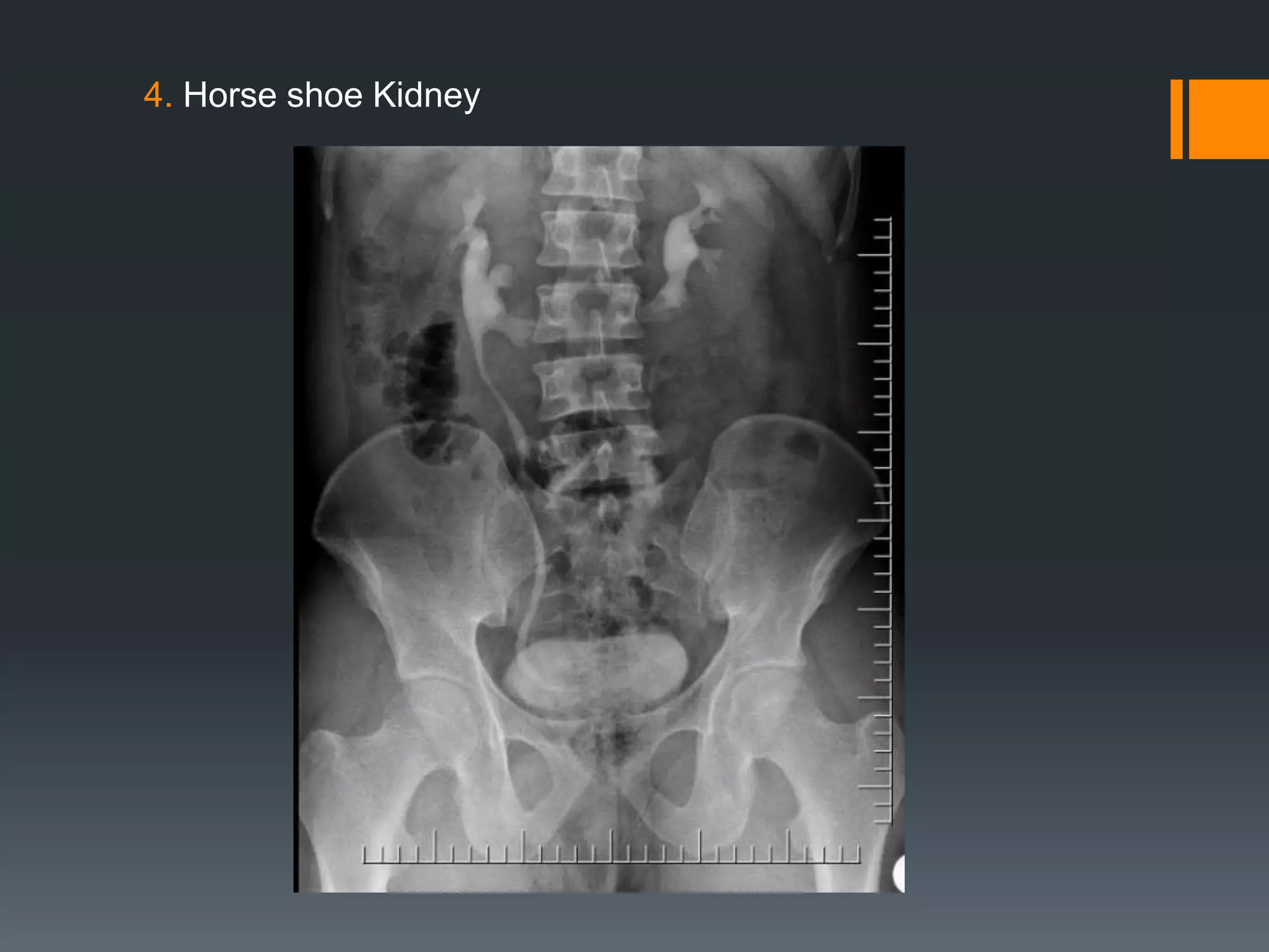 Kub - xray and usg | PPTX