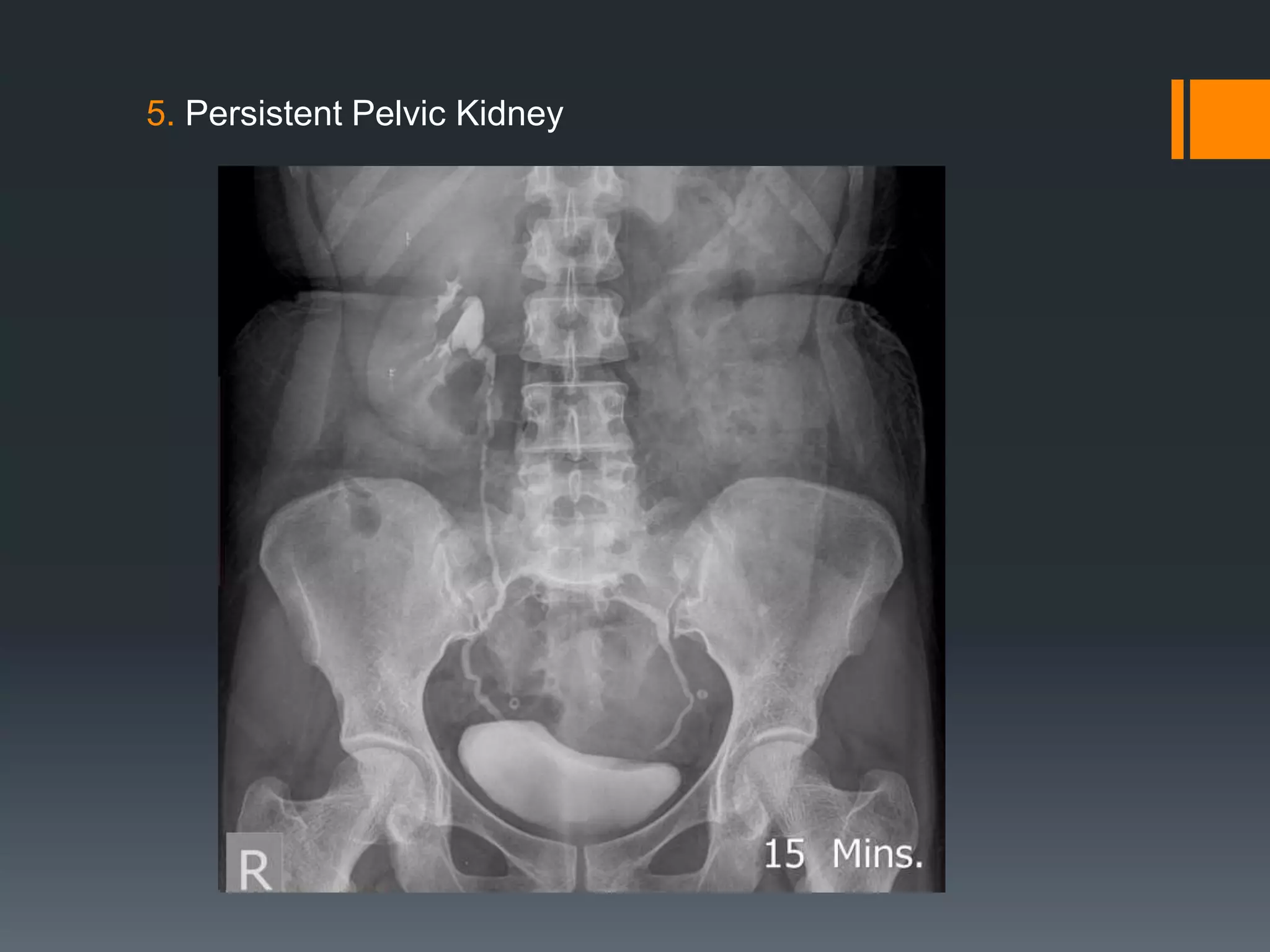 Kub - xray and usg | PPTX