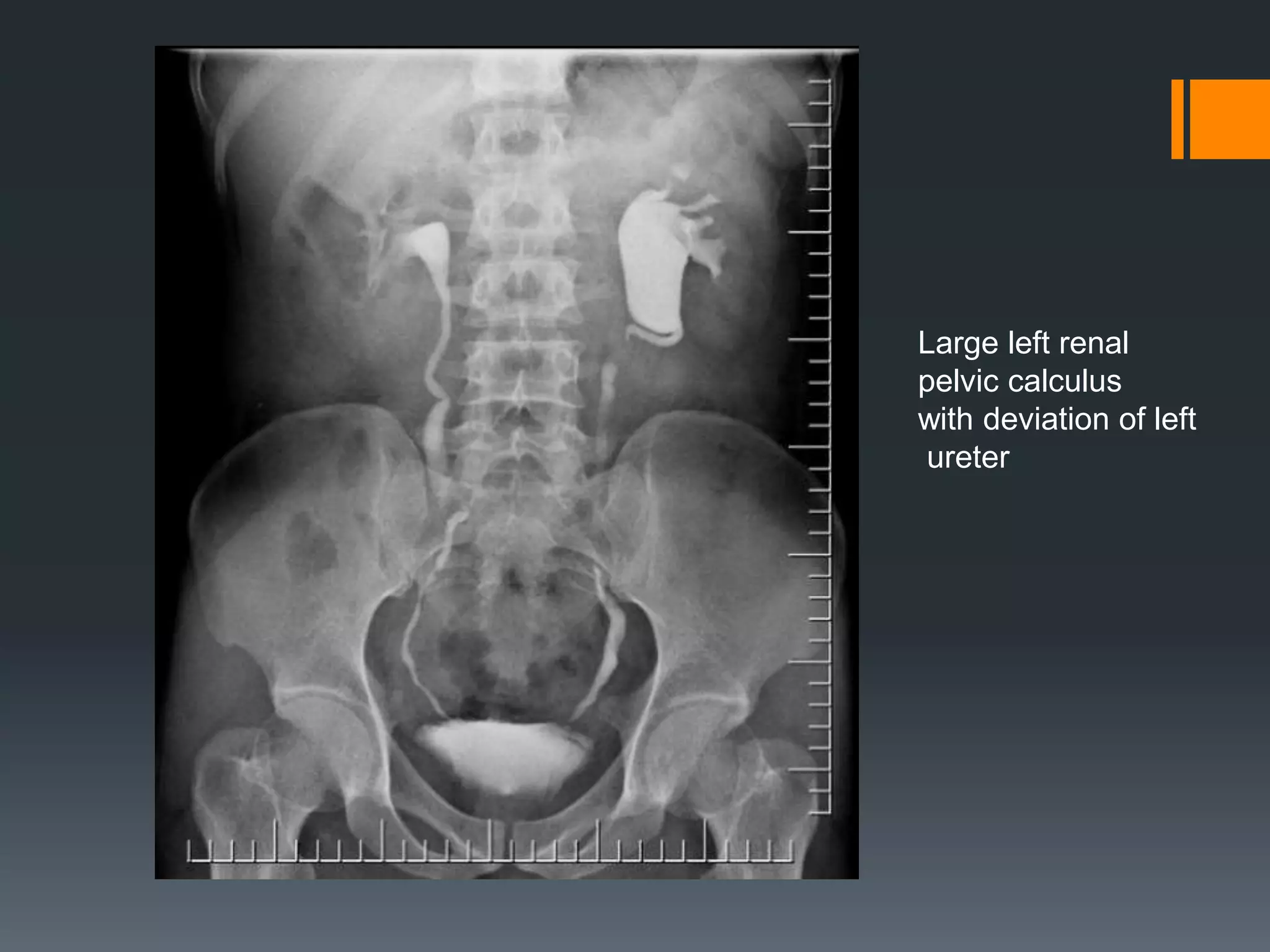 Kub - xray and usg | PPTX