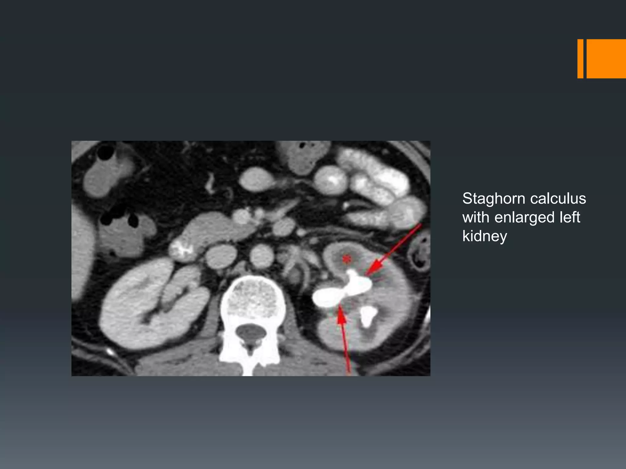 Kub - xray and usg | PPTX