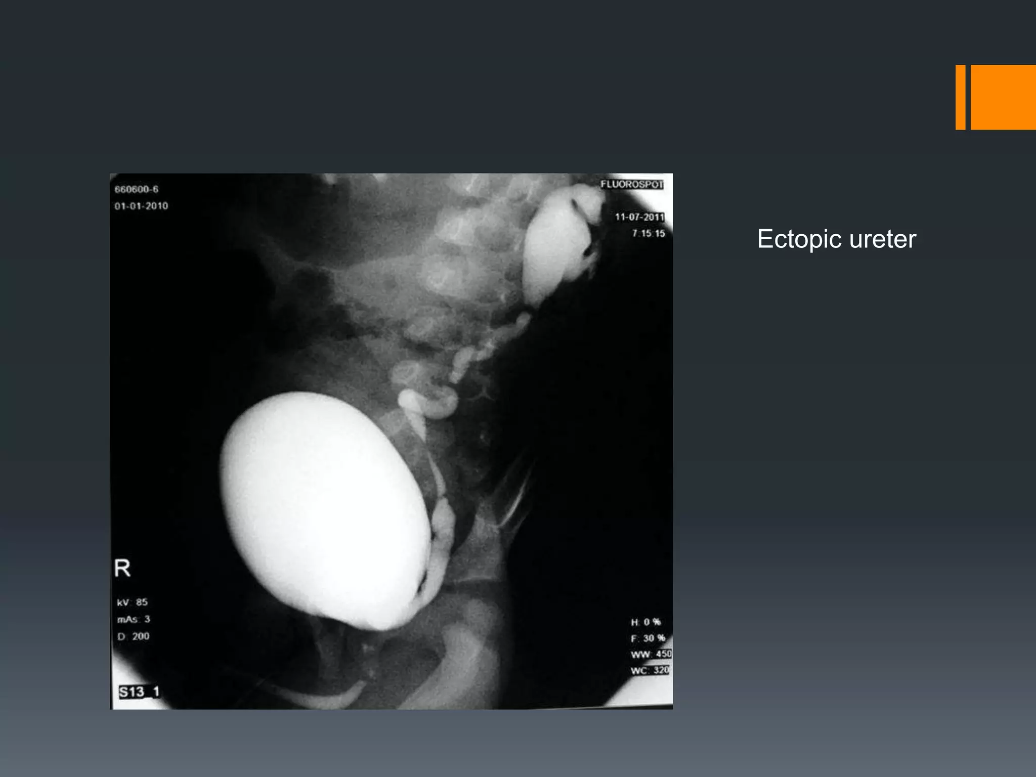 Kub - xray and usg | PPTX