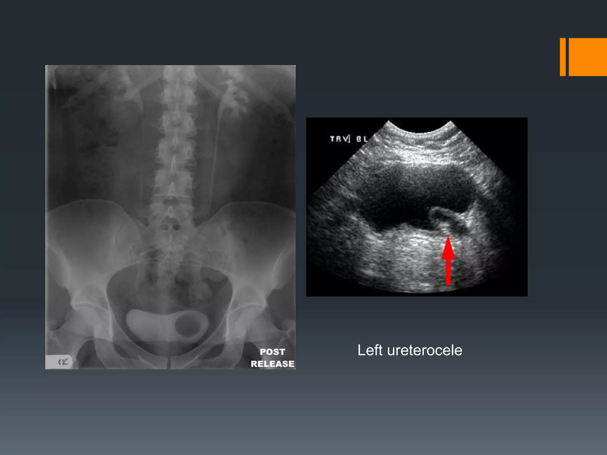 Kub - xray and usg | PPTX